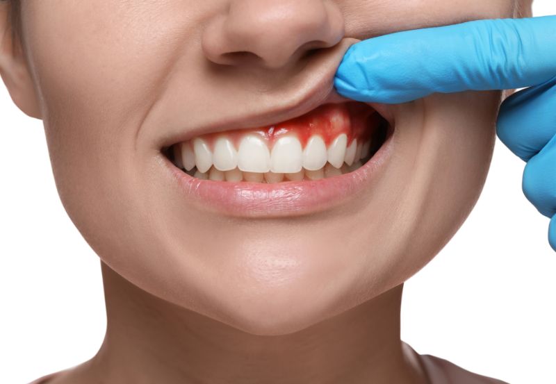 Opryszczkowe zapalenie jamy ustnej – objawy, leczenie i wpływ na ...